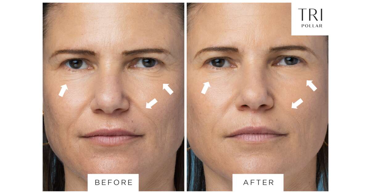 TriPollar STOP Vx GOLD2 rádiófrekvenciás arcápoló - MULTI-RF, Turbo RF, DMA technológiával ...