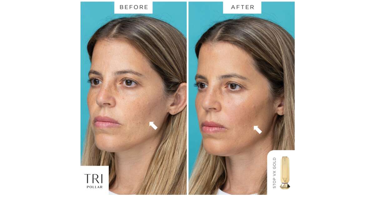 TriPollar STOP Vx GOLD MULTI-RF Radio frequency, with DMA technology ...